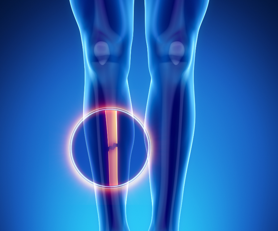 Cracks vs. Breaks – SK Radiology